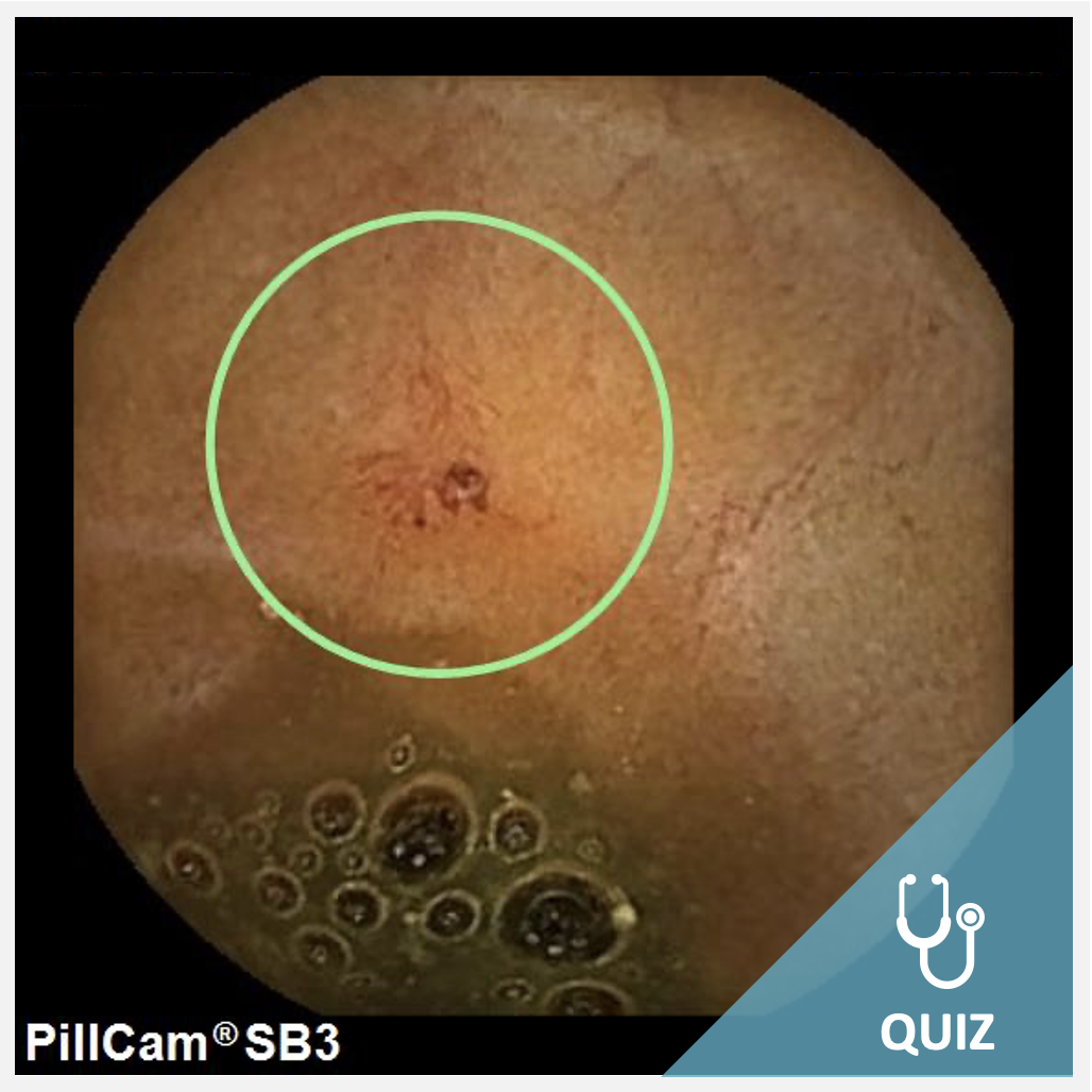 High-Risk Angiodysplasia Detection